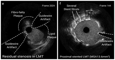 Case 8 Ivus Guided Lm Trifurcation Pci Cardiology Apps