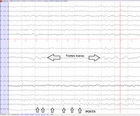 POSTS Positive Occipital Sharp Transients Of Sleep EEGpedia