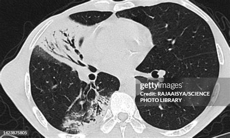 Bronchogram Of Lung Fotografías E Imágenes De Stock Getty Images