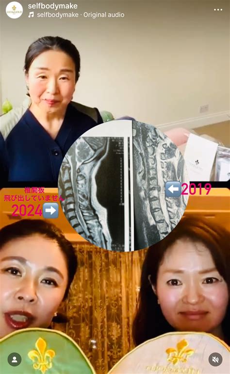 My Herniated Disc Surgery Is No Longer Necessary