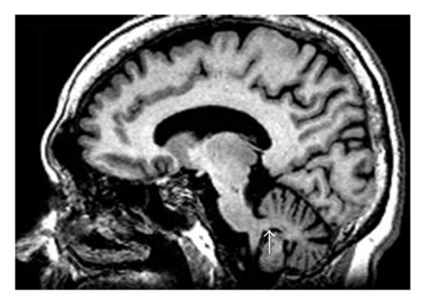 Mri Findings In Msa A Bilateral Posterior Putaminal T2 Hypointensity