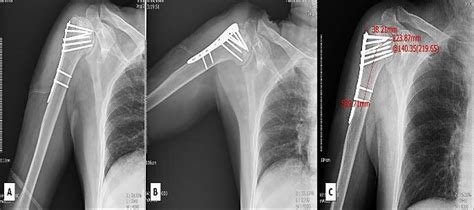 Anterior Posterior Ap Radiography The Proximal Humerus Internal Download Scientific Diagram