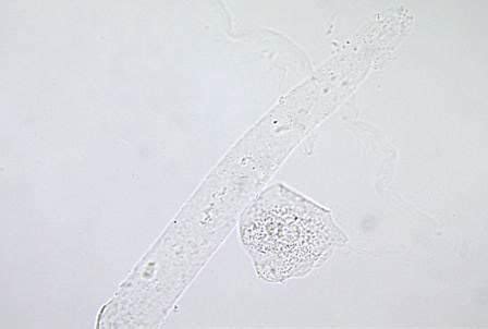 Hyaline Cast In Urine Casts Eclinpath