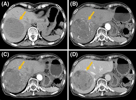 Abdominal Dynamic CT Image Reveals A 98 Mm Mass In The Right Lobe Of