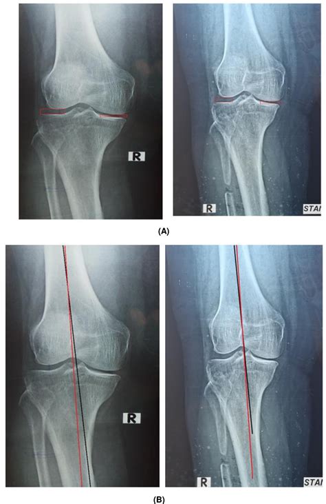 Proximal Fibular Osteotomy In Treatment Of Medial Unicompartmental Knee Osteoarthritis In