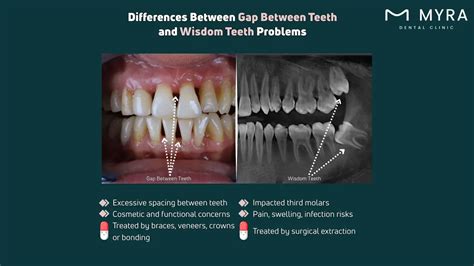Gap Between Teeth Symptoms Treatment Causes