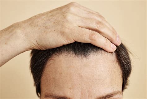 Scalp Biopsy For Hair Loss What You Should Know