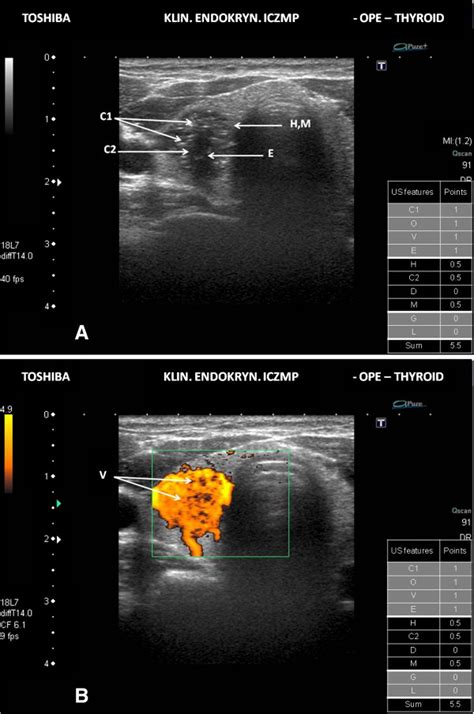 Intermediate Risk Thyroid Nodule Focal Lesion Us Pattern A Ultrasound Download Scientific