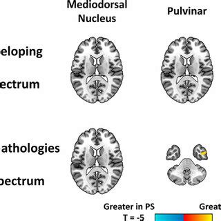 Age A Sex B And Group C Effects In Predefined Thalamocortical Download Scientific