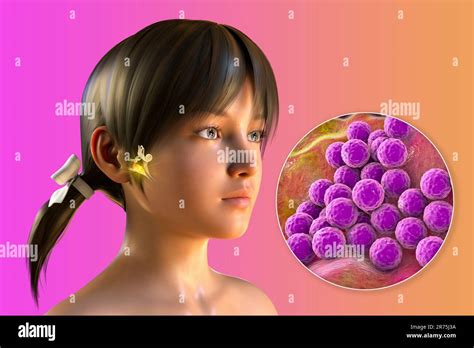 Otitis Media Ear Infection Caused By Staphylococcus Aureus Bacteria Computer Illustration S
