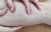 Why Are My Veins So Visible