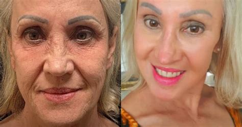 Peeling De Fenol Antes E Depois De Tratamento Estético Viraliza No Tik