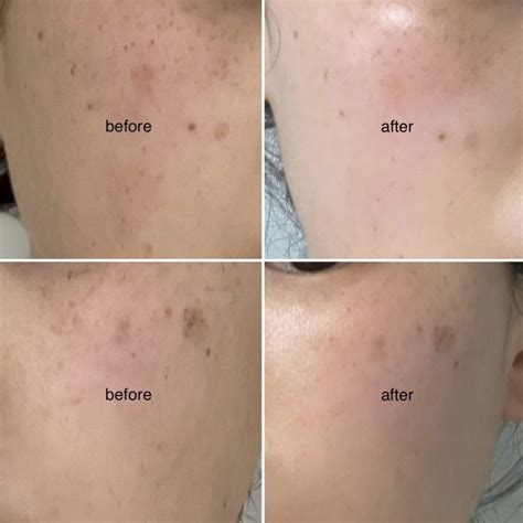 내돈내산 피코하이 토닝 1회차 솔직후기 대구 피부과 중앙로역 피부과 네이버 블로그