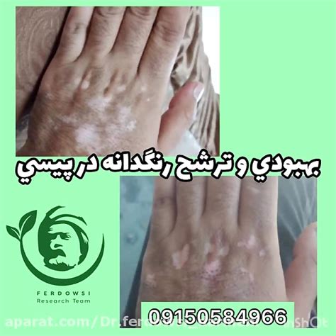 درمان گیاهی پیسی در کمترین زمان