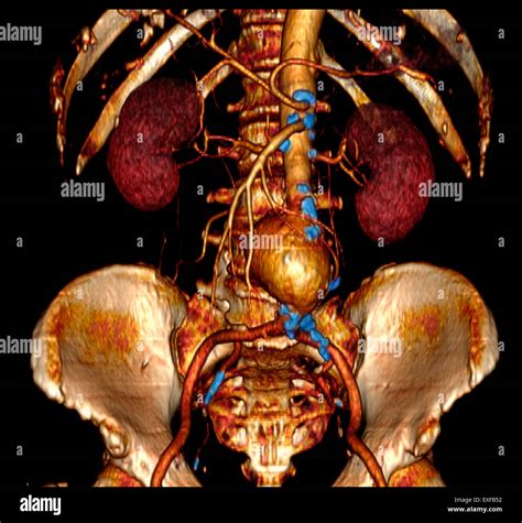 3d Abdominal Angiographic Ct Scan Abdominal Aortic Aneurysm Calcifications Along Aorta