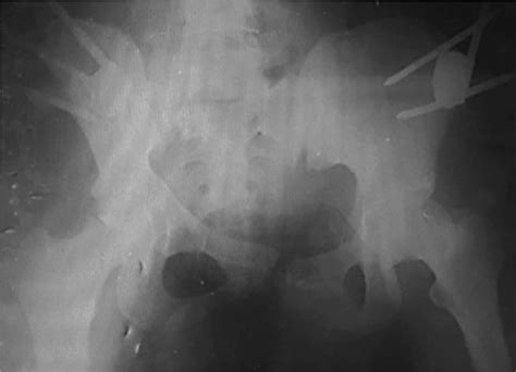 Preoperative Imaging Of The Pelvic Fracture Download Scientific Diagram