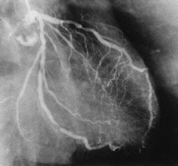 Thoracic And Cardiovascular Interventions After Orthotopic Heart