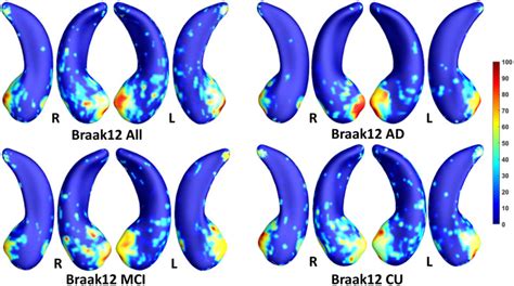 Federated Morphometry Feature Selection For Hippocampal Morphometry Associated Beta Amyloid And
