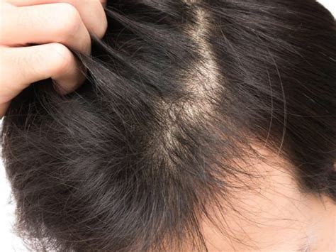 Dht Y Dihidrotestosterona Funciones Efectos Y Control Itc Medical