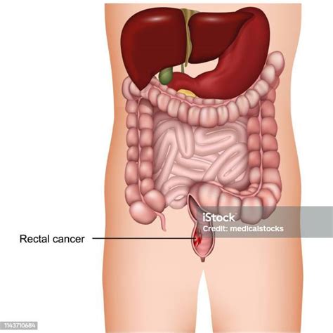 직장 암 흰색 바탕에 의료 3d 벡터 일러스트 레이 션 대 장 암 암에 대한 스톡 벡터 아트 및 기타 이미지 암 암종 항문 Istock