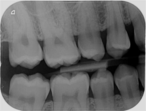 Radiographic In Dental Radiography Errors
