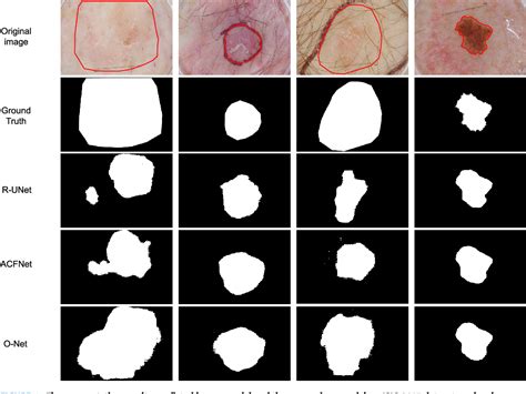 Figure From Skin Lesion Segmentation Using Recurrent Attentional Convolutional Networks