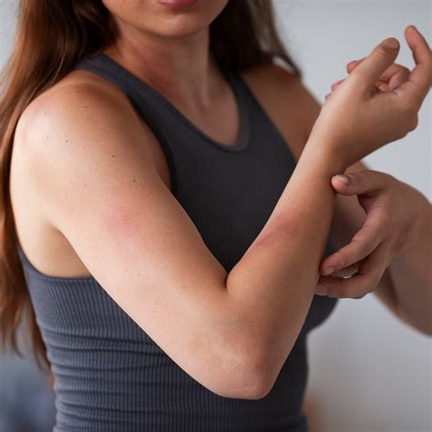 Do Carpet Beetles Bite A Pest Experts Guide To The Real Problem