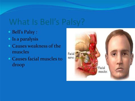 What Causes Bells Palsy In Babies Medicalopedia Images And Photos Finder