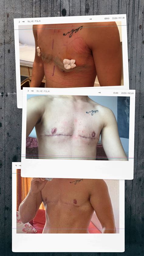 Transgender Genital Surgery Before And After