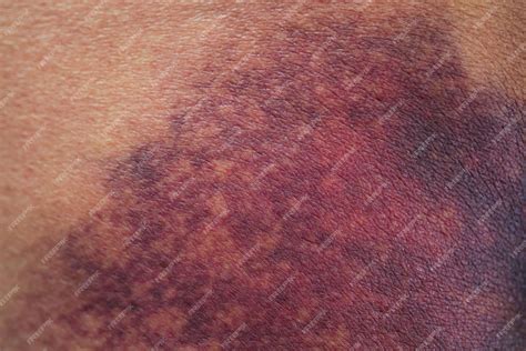 Premium Photo Asian Woman Dark Bruise On The Buttocks From A Slip