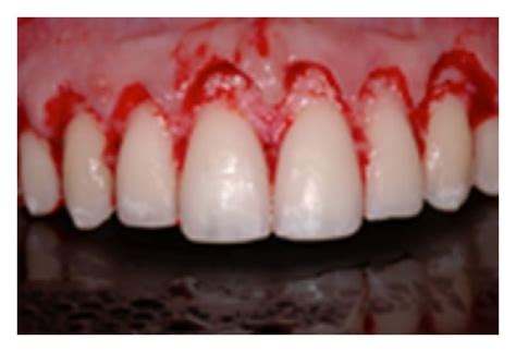 Flap Elevation Displays The Condition Download Scientific Diagram