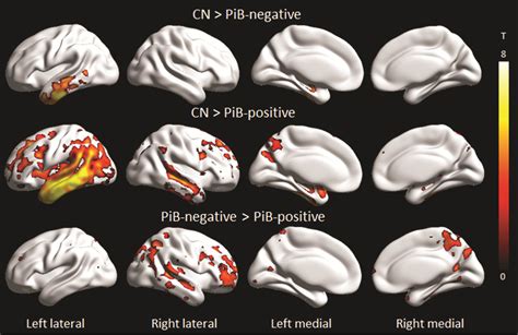 Figure 1 From Clinical And Neuroimaging Biomarkers Of Amyloid Negative Logopenic Primary
