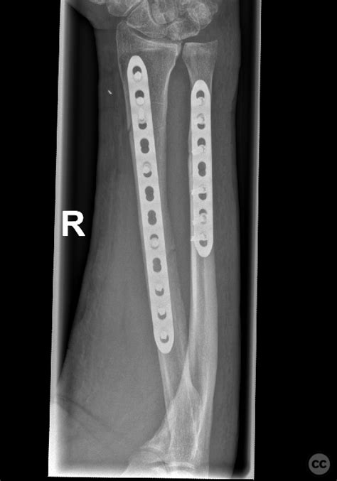 Henrys Approach To A Segmental Radial Shaft Fracture
