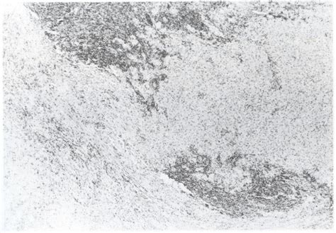 Case 1 Photomicrograph Showing A Lymph Node And Adjacent Tissue There Download Scientific