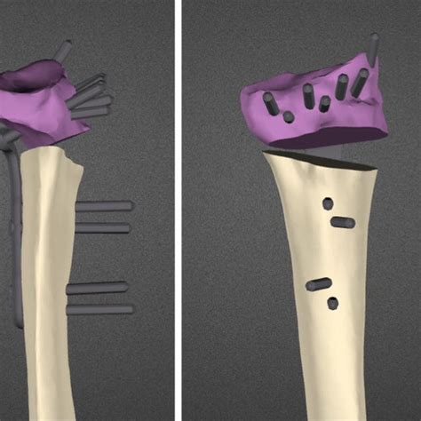 Virtual Corrective Osteotomy Of The Distal Radius And Simulation Of Download Scientific Diagram