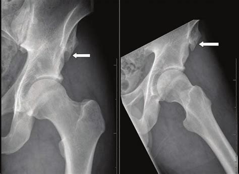 A Frontal Radiograph Of The Pelvis Demonstrating Bilateral Bony