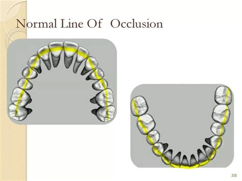 Classification Of Malocclusion Pptx