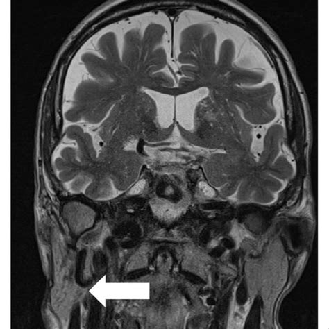 Intraoperative View Of Tympanic Segment Of The Facial Nerve Large Download Scientific Diagram