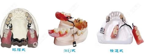 精密附着体义齿有几种 按扣式 套筒冠 磁性附着体等6种类型 行业动态 容易美口腔