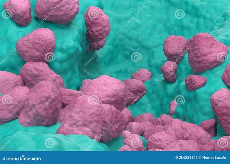 Non Small Cell Lung Cancer Nsclc In The Lung Tissue â€“ Closeup View 3d Illustration Stock