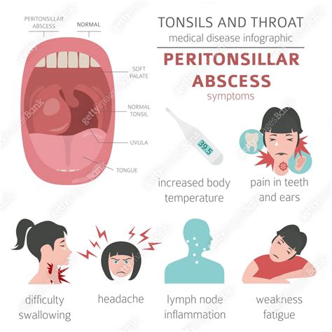 Tonsils And Throat Diseases Peritonsillar Abscess Symptoms Treatment