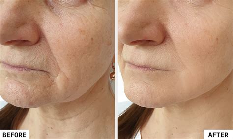 Ultracel Q Hifu The Best Non Surgical Skin Lifting Treatment
