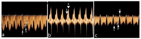 A Typical Flow Velocity Waveform Of The Ductus Venosus Dv Including