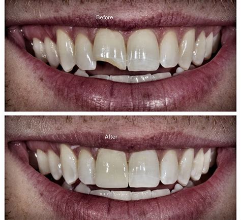 Front Tooth Cavity Before And After What Causes Cavity On Front Tooth