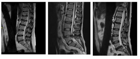 Diagram Of Mri Disc Herniation Stages Labelling Quizlet
