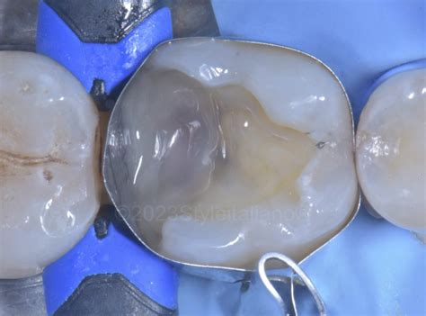 One Stage Direct Surgical Restorative Approach In Extensive Class Ii