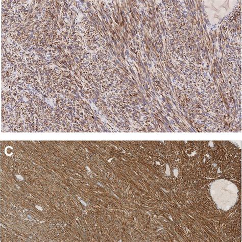 Immunohistochemical Staining Of The Leiomyosarcoma Original