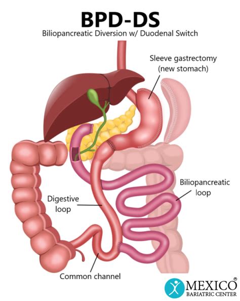 Single Anastamosis Duodenal Switch Mexico Bariatric Center