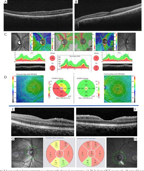 Figure 2 From Optical Coherence Tomography In Compressive Lesions Of The Anterior Visual Pathway