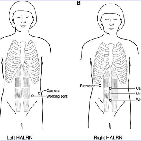 Right Hand Assisted Laparoscopic Radical Nephrectomy Using A Midline Download Scientific